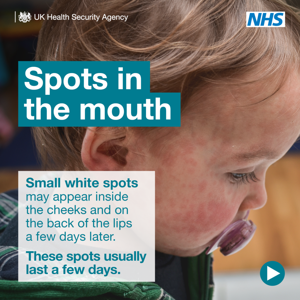 Measles - Goring & Woodcote Medical Practice